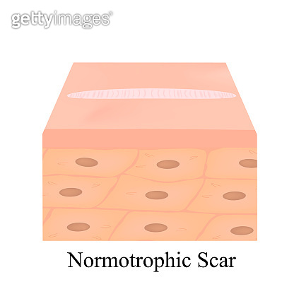 Scars normotrophic. The anatomical structure of the skin scar. Vector ...