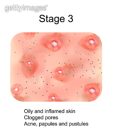 Stage 3 of development of acne. Inflamed skin with scars, acne and ...