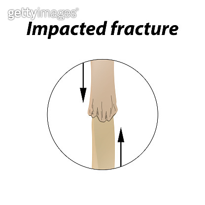 Impacted fracture Bone. Infographics. Vector illustration on a lined ...