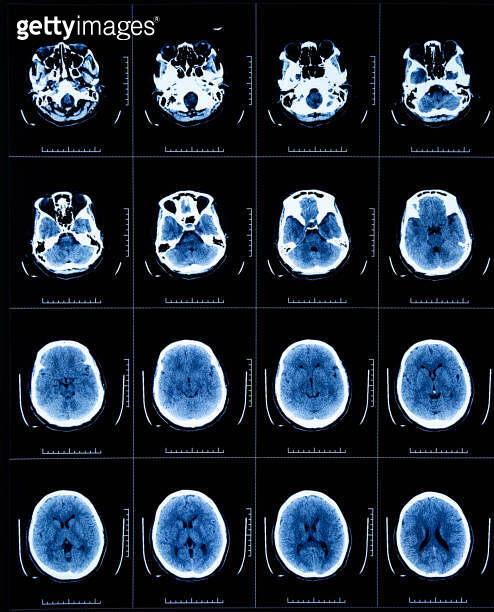 MRI scan human head Tomography 이미지 (1193521323) - 게티이미지뱅크
