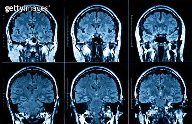 MRI scan human head Tomography (1193103139) - 게티이미지뱅크