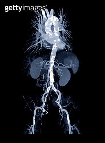 CTA Abdominal aorta 3D rendering name is Maximum intensity projection ...