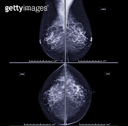 X-ray Digital Mammogram both side CC view and MLO . mammography or ...
