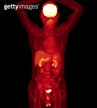 PET Scan image of whole body Coronal plane with MIP technique . medical ...