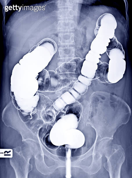 barium enema image AP View showing the colon and rectum under ...