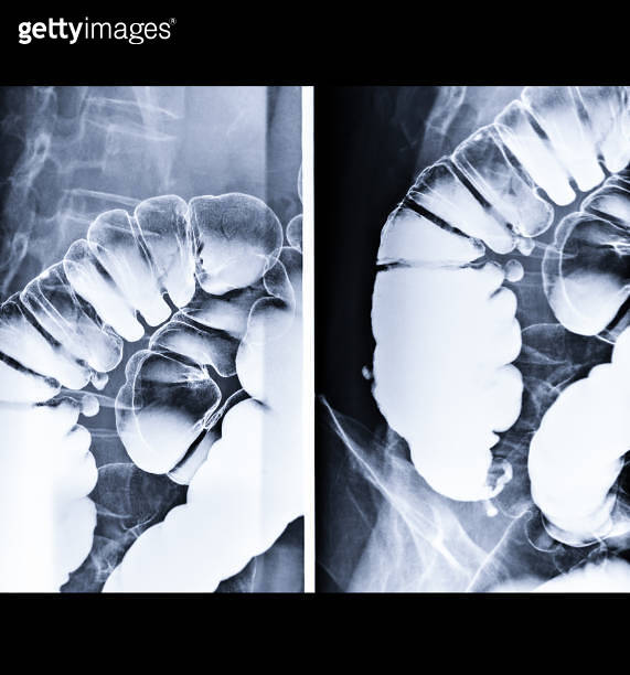 barium enema image AP View showing the colon and rectum under ...