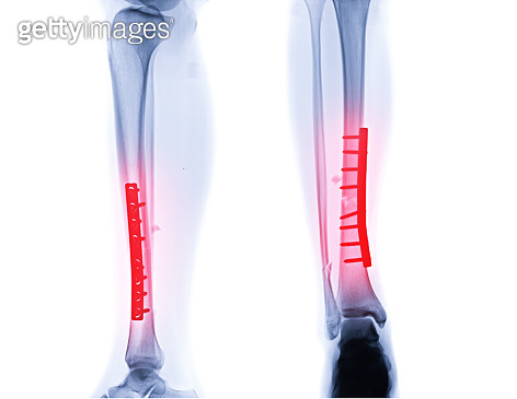 X-ray image of fractured leg with surgical treatment by internal ...