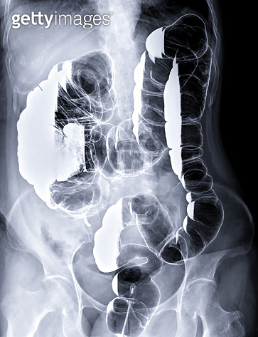 barium enema image or BE right lateral decubitus view showing air and ...