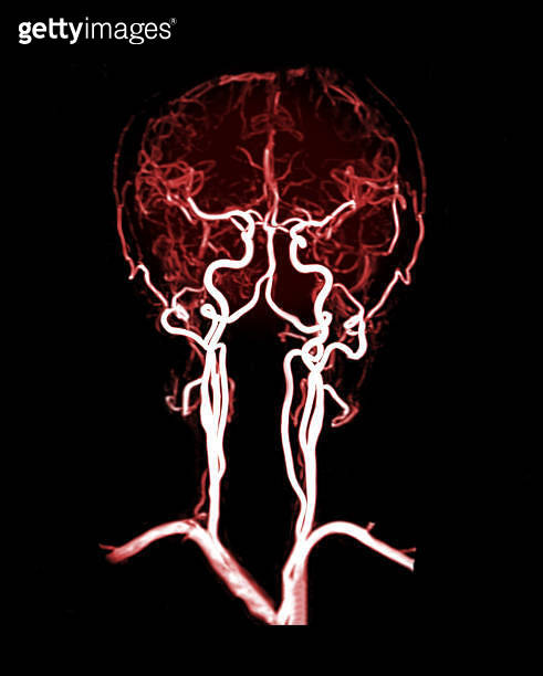 MRA brain Coronal 3D MIP view showing Common carotid artery and ...