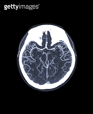 CTA brain or CT angiography of the brain Axial mip view. medical ...