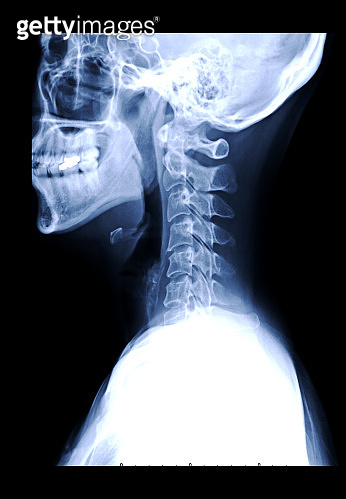 X-ray C-spine or x-ray image of Cervical spine lateral view for ...