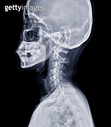 X-ray C-spine or x-ray image of Cervical spine Lateral view for ...