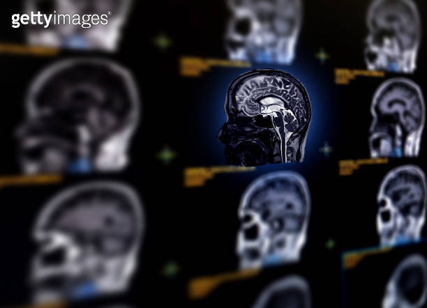 Selective focus of MRI brain sagittal plane with blue color glowing ...