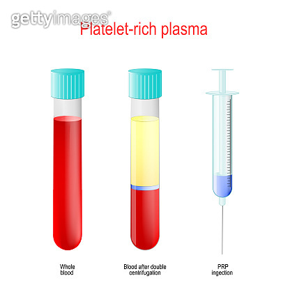 PRP. Two test tubes and syringe with blood and platelet-rich plasma ...
