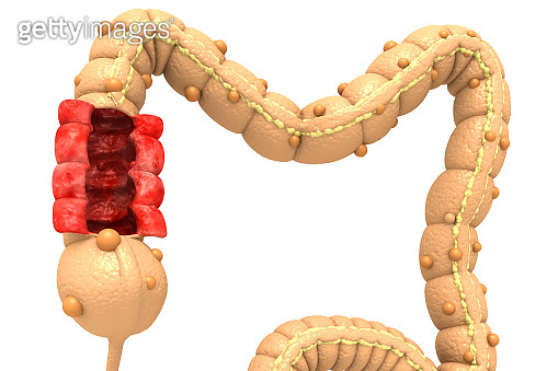 Human colon. Colon anatomy 이미지 (1158597425) - 게티이미지뱅크