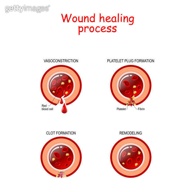 Phases of the wound healing process. poster with capillary, red blood ...