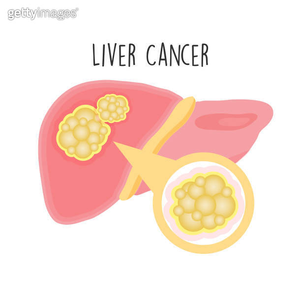 Liver cancer diagram .Vector illustration in flat style. (1183533160 ...