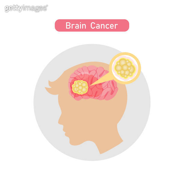 Brain cancer diagram .Vector illustration in flat style. 이미지 ...