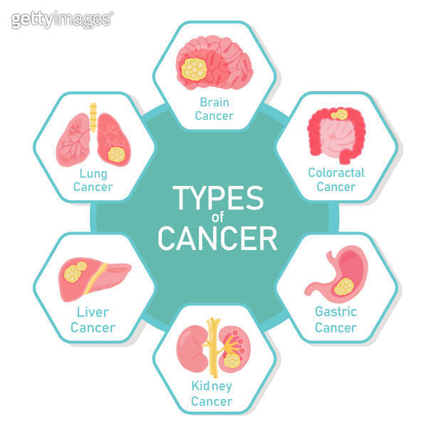 Types of Cancer infographics Vector Illustration. (1184109834) 일러스트, 무료 ...