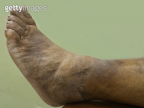 A woman's leg swollen with bacterial skin infection called: erysipelas ...