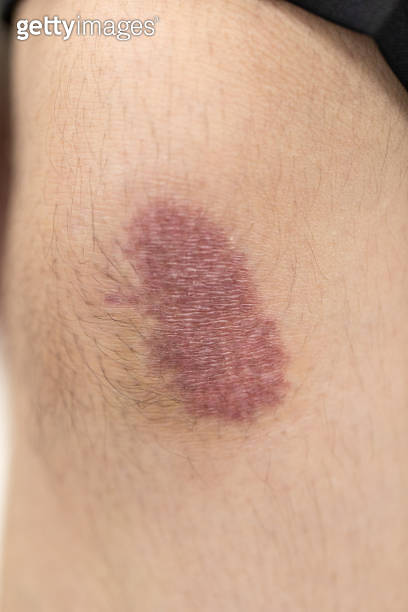 Closeup injured at leg, Fresh wounds from accident. 이미지 (1181203143 ...