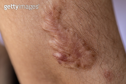 A scar is an area of fibrous tissue that replaces normal skin after an ...