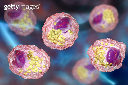 Foam Cell A Macrophage Cell With Lipid Droplets 이미지 1147822435 게티이미지뱅크