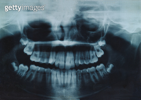 Panoramic dental and mandible x-ray image with intact teeth and four ...