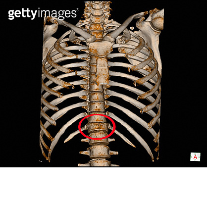 Thoracic spine ct with 3D reconstruction . The film shown thoracolumbar ...