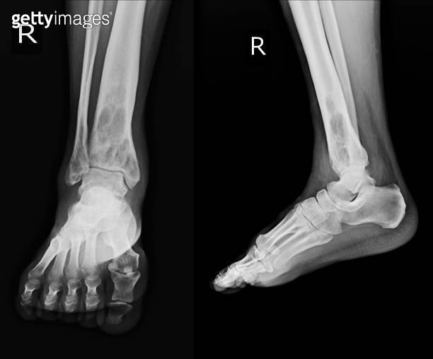 X-ray Rt.Ankle finding intramedullary osterolytic lesion of right ...
