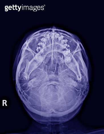 Film mandible AP showed Fracture of body and angle of Mandible 이미지 ...