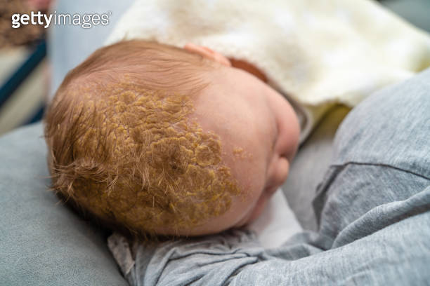 Baby head with dermatologic problem Cradle Cap Seborrheic Dermatitis ...