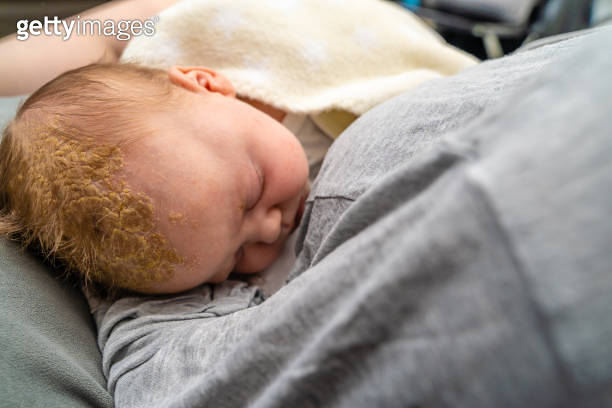 Baby with dermatologic problem Cradle Cap Seborrheic Dermatitis ...