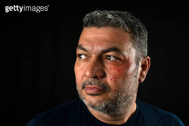 portrait of mature man with injured face (1204152587) - 게티이미지뱅크