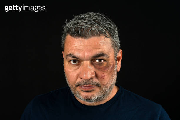 portrait of mature man with injured face (1204620046) - 게티이미지뱅크