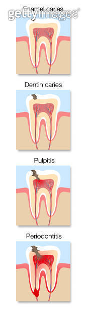 Caries development infographic, stages with cross section of tooth ...