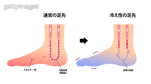 Comparison illustration of normal foot and cold foot ( sensitivity to ...
