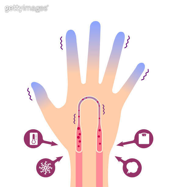 Cold hand blood circulation illustration (sensitivity to cold, cold ...