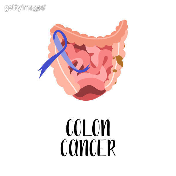 Colon cancer, carcinoma. Dark blue awareness ribbon. Oncology ...