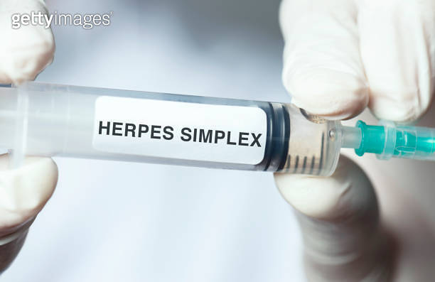 Herpes Simplex 이미지 (1245001603) - 게티이미지뱅크