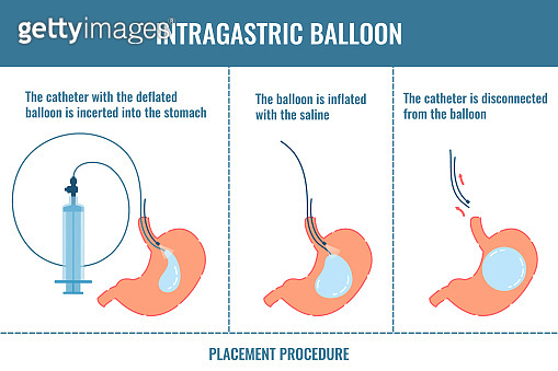 Gastric balloon weight loss procedure phases shown in stomach 이미지 ...