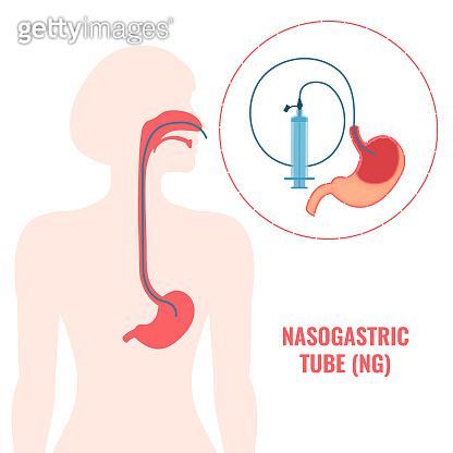 Nasogastric enteral feeding tube passed to stomach infographics 이미지 ...