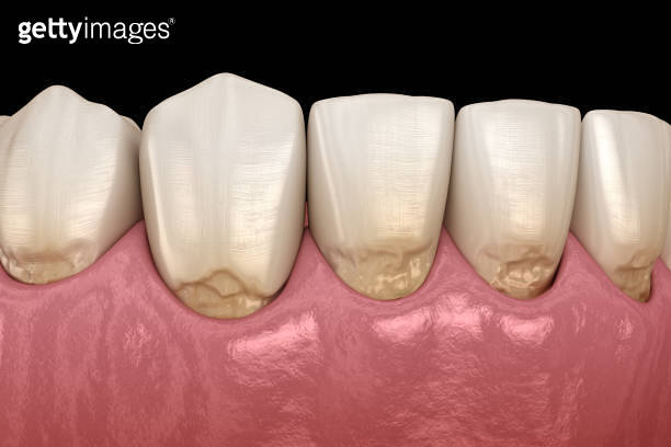 Abfraction of anterior teeth. Medically accurate 3D illustration ...