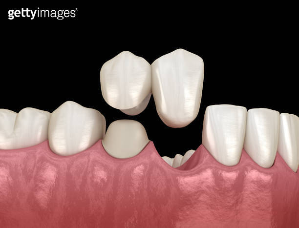 Cantilever bridge made from ceramic, frontal tooth recovery. Medically ...