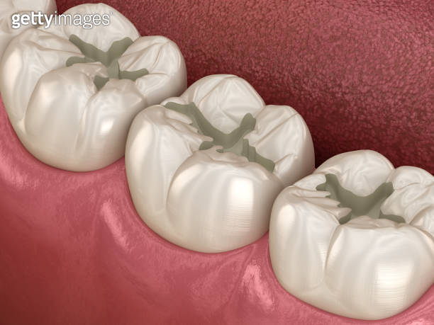 Prepareted Molar Fissure for fillings placement, Medically accurate 3D ...