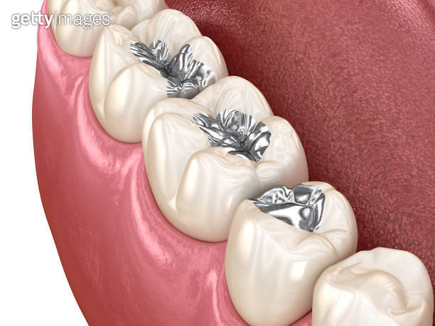 Amalgam restoration. Medically accurate 3D animation of dental concept ...