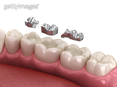 Amalgam restoration. Medically accurate 3D animation of dental concept ...