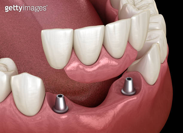 Frontal teeth bridge supported by implants. Medically accurate 3D ...