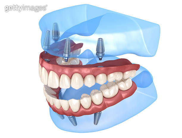 Maxillary and Mandibular prosthesis with gum All on 4 system supported ...