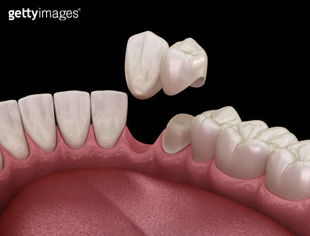 Cantilever bridge made from ceramic, frontal tooth recovery. Medically ...